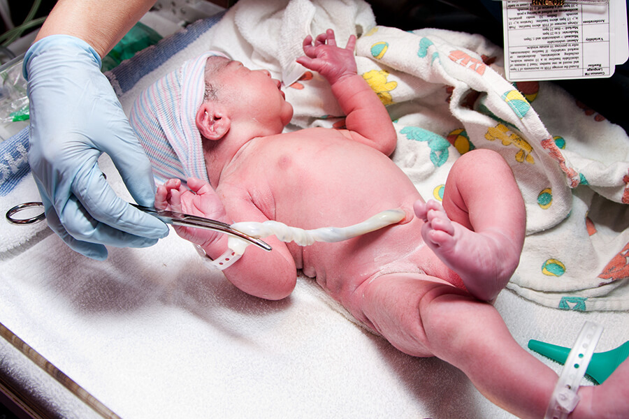 Delayed Cord Clamping MyObMD Delayed Cord Clamping MyObMD